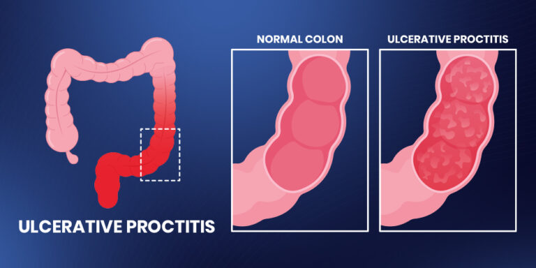 Ulcerative Proctitis: Symptoms, Causes and Treatment Options