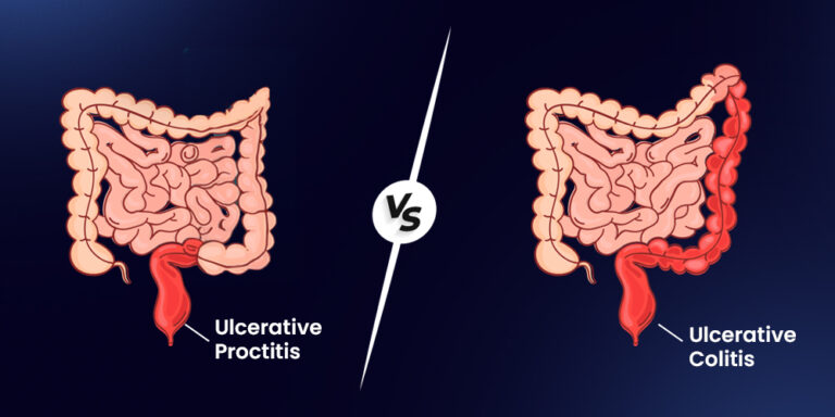 Ulcerative Proctitis vs Ulcerative Colitis: Key Differences