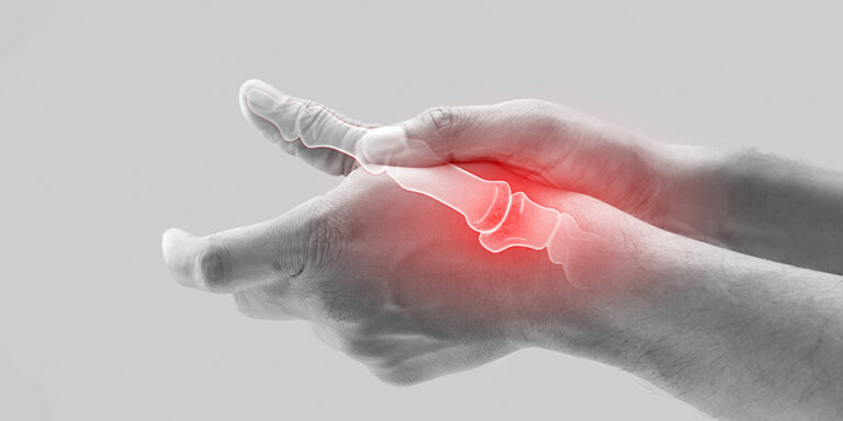 How Seronegative Rheumatoid Arthritis Is Diagnosed Guide